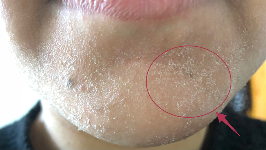PCOS Facial Hair: Everything You Need To Know